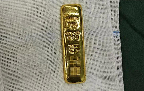 Випадково проковтнув: у шлунку 11-річного хлопчика знайшли золотий злиток